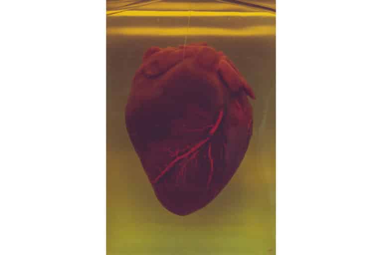 Extrasistole ventriculare - Cardio Clinic