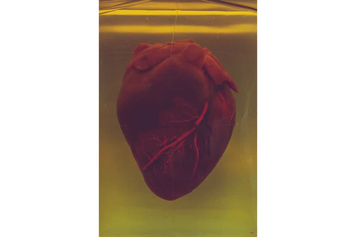 Extrasistole ventriculare - Cardio Clinic